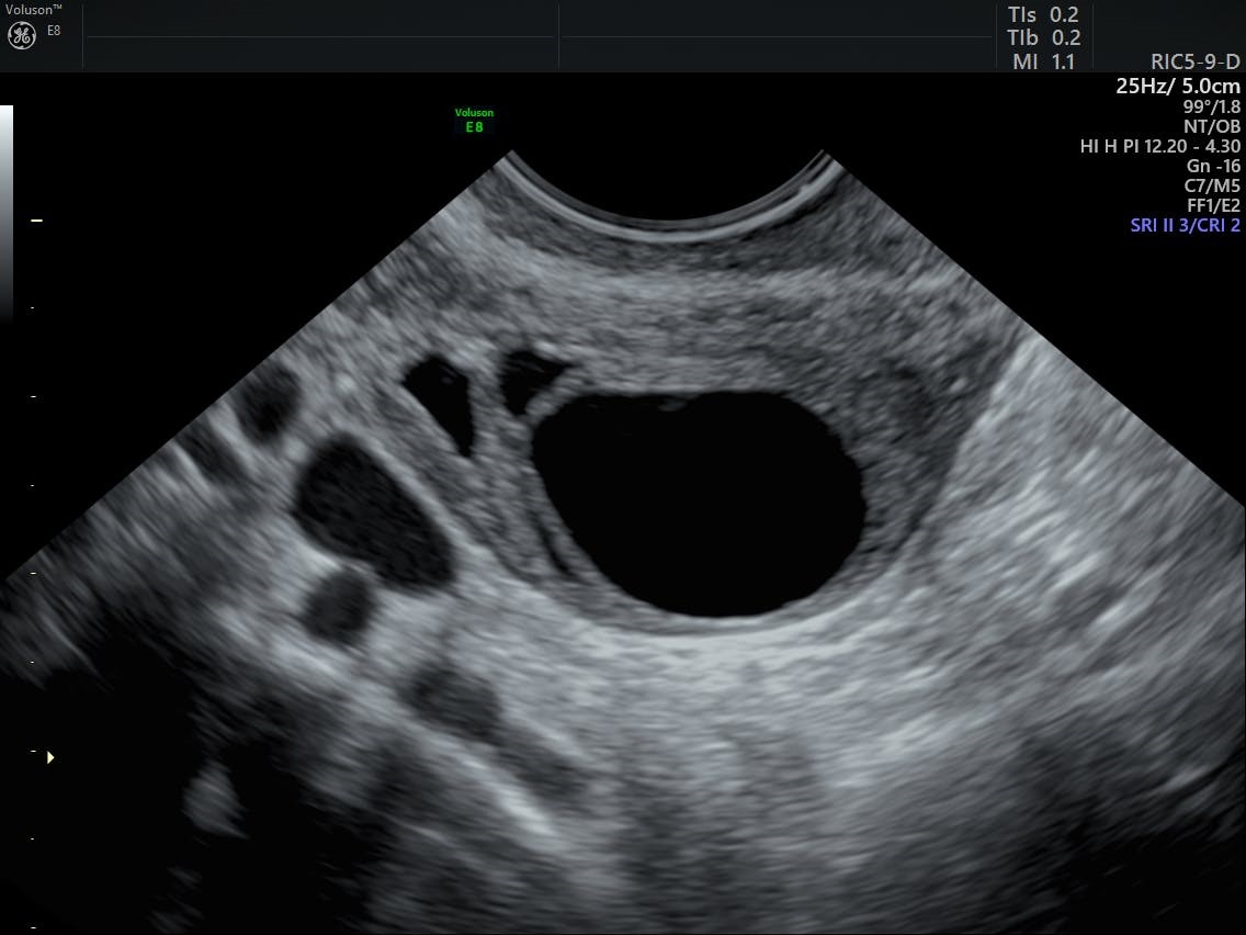 Ovarian Cysts In Fertility Patients Helping To Create New Beginnings Fertility Institute Of