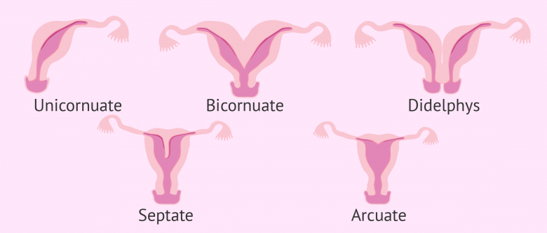 Müllerian Anomalies Diagnosis And Management Of Abnormal Uterine
