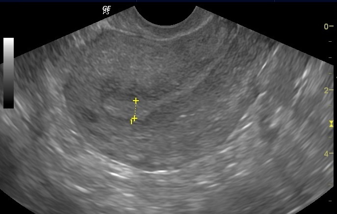 Fertility Testing – Uterine Cavity Evaluation | FIH